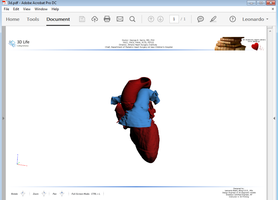 Anomalous Aortic Origin of Left Coronary Artery (AAOLCA) | 3D Life