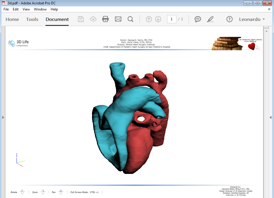 Hypoplastic distal Aortic Arch with Coarctation of Aorta | 3D Life