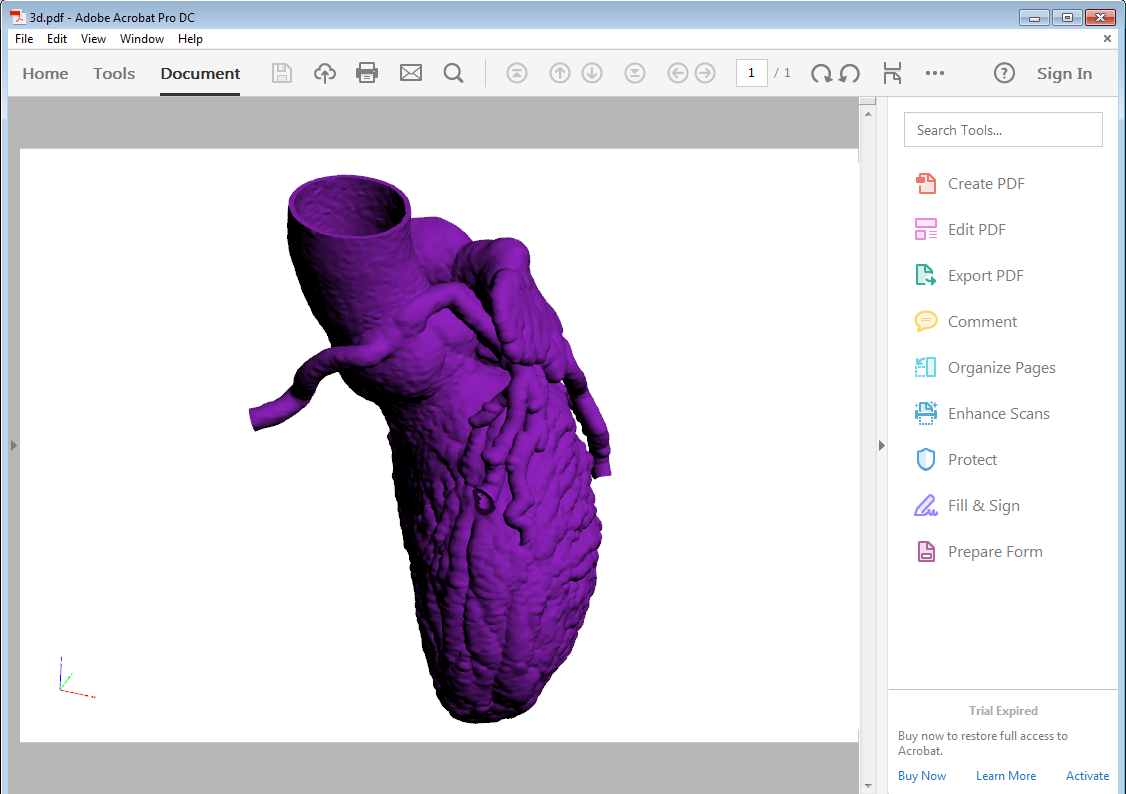 Anomalous Aortic Origin of Left Coronary Artery (AAOLCA) | 3D Life
