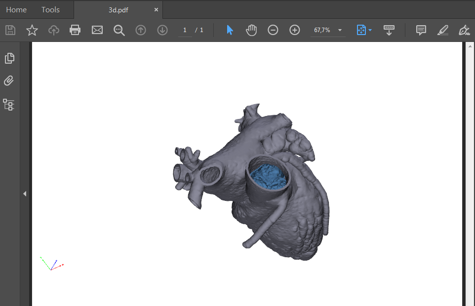 Tricuspid Aortic Valve | 3D Life