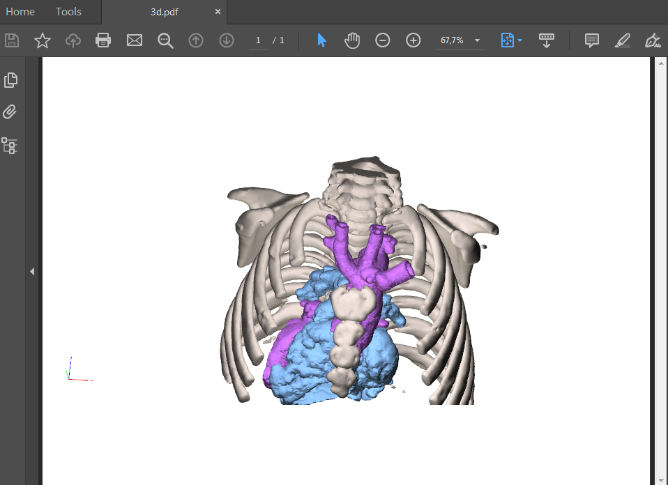 Palliated TGA-PS with Central shunt | 3D Life