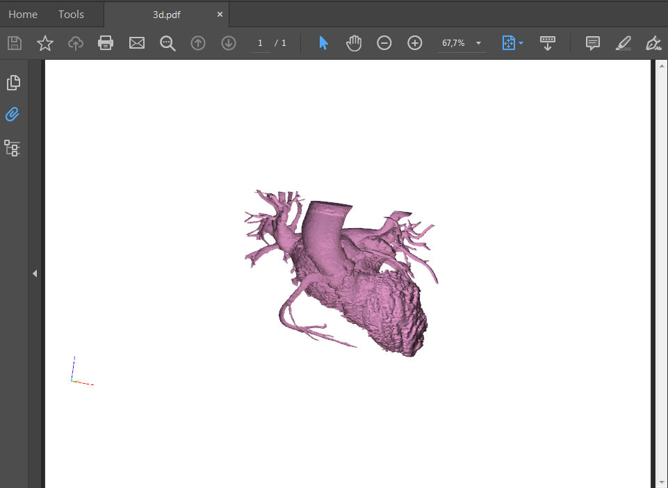 Biological Aortic valve stenosis | 3D Life