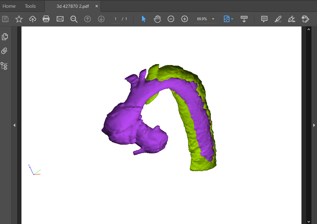 Dissection of Aorta Repair | 3D Life